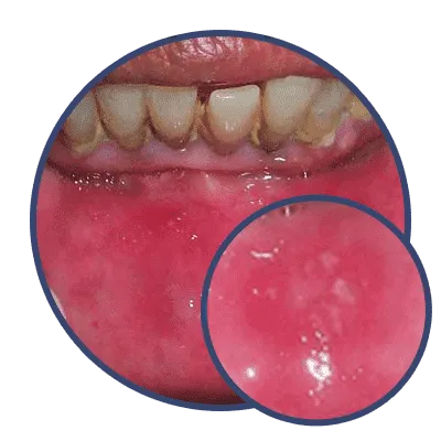 sharp teeth mouth ulcers